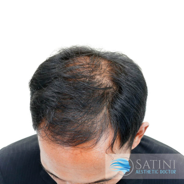 Topical Finasteride 0.25% + Minoxidil 5%-Trichoboost Superior Hair ...