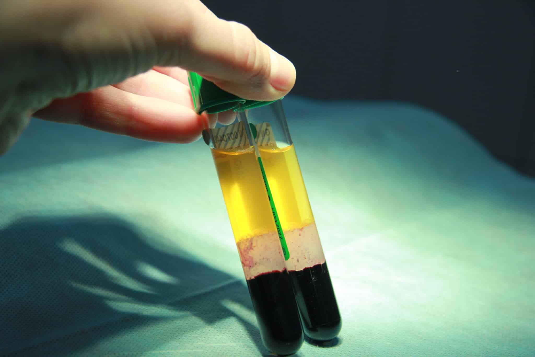 An Introduction To Vampire or Blood Facial