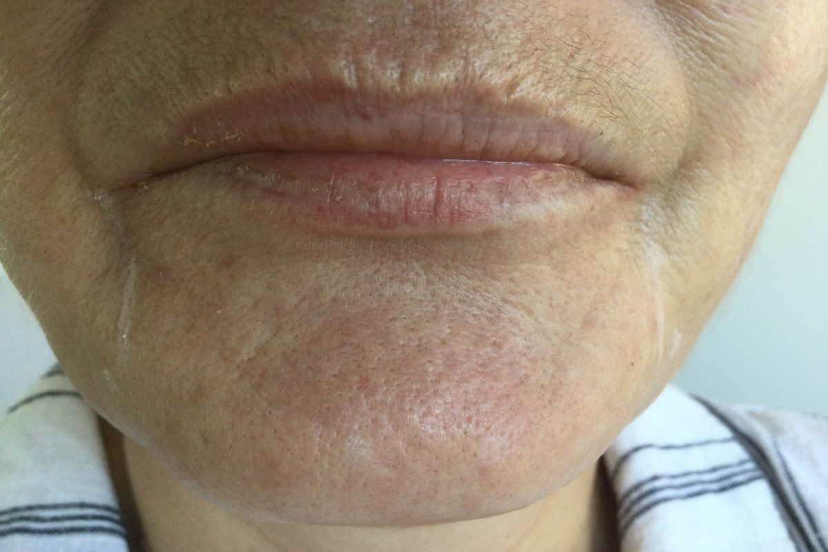 Dermal filler for upper lip lines