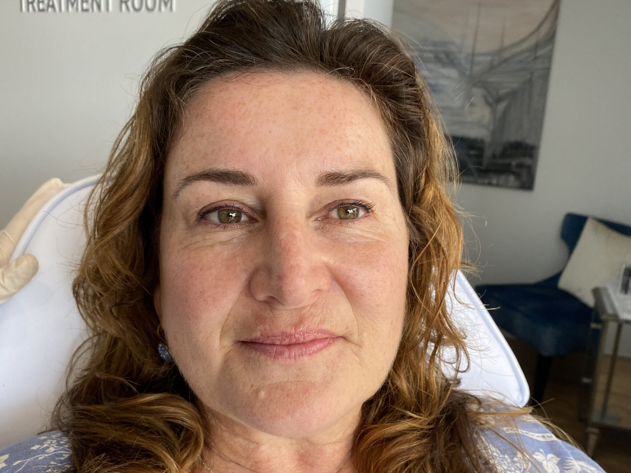 Where to get the hippest lip fillers in chch | Satini Cosmetic Clinic