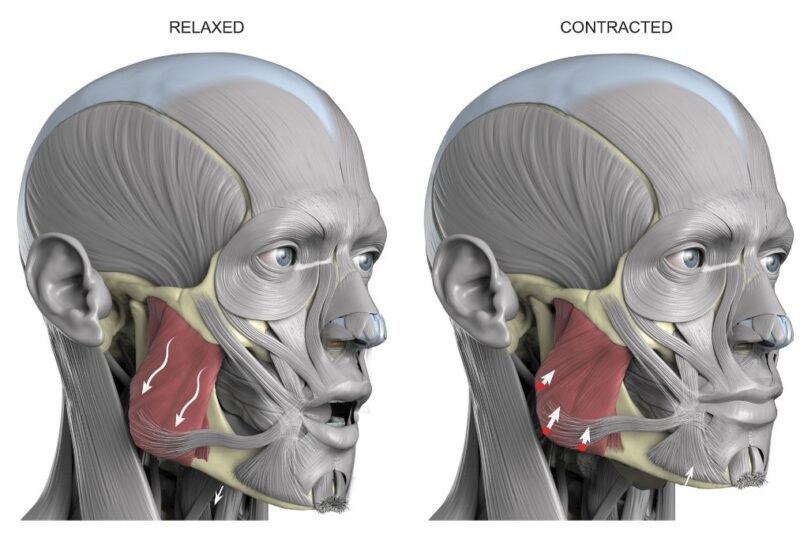 Masseter Botox for Slimming the Face: How It Works