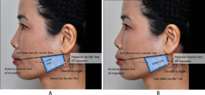 Masseter Botox for Slimming the Face: How It Works