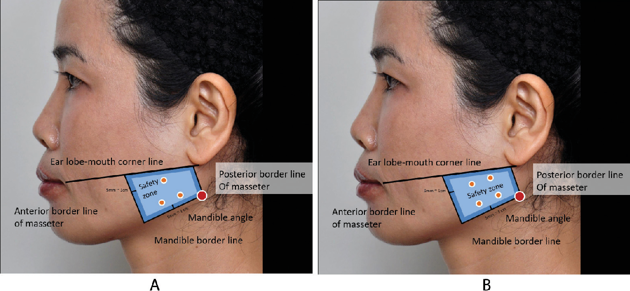Masseter Botox for Slimming the Face: How It Works