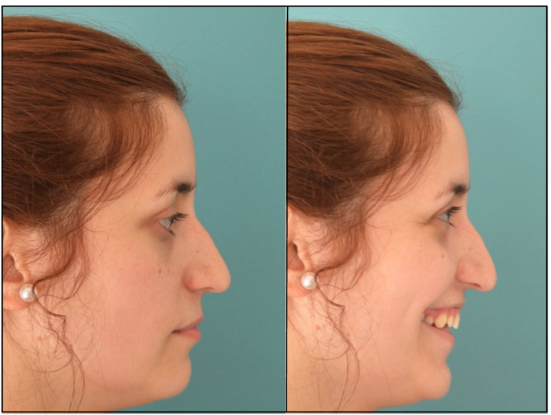 Botox For Slimming Of The Nose