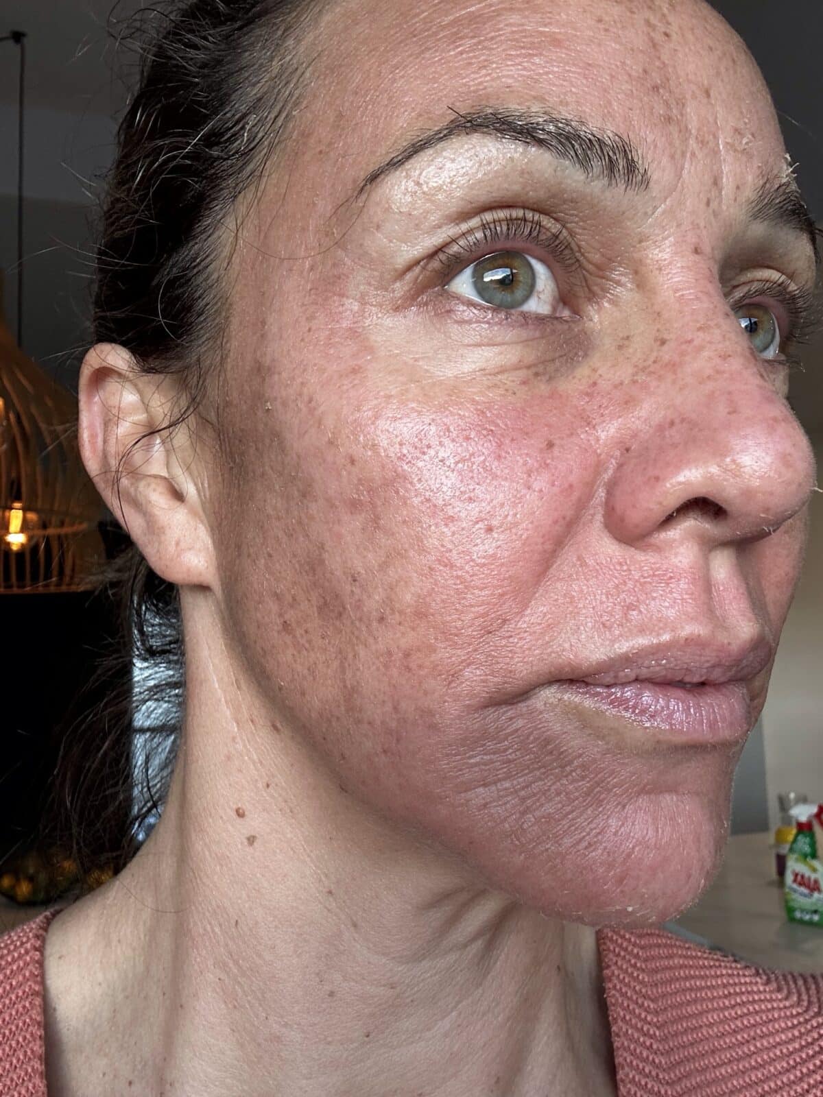 Watch Jessie During Her Cosmelan Journey