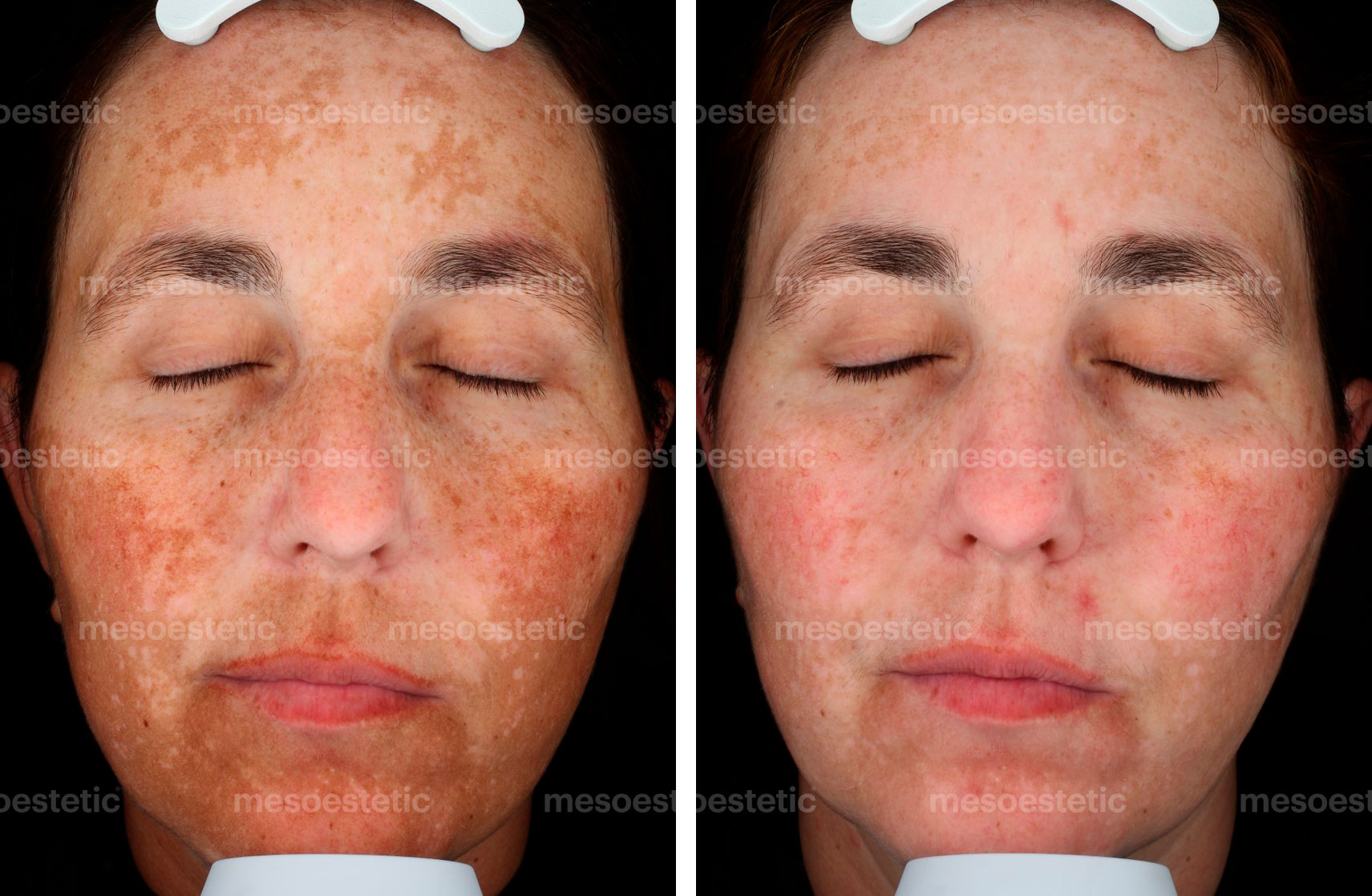 The New Dermamelan: Safer, Easier And More Effective