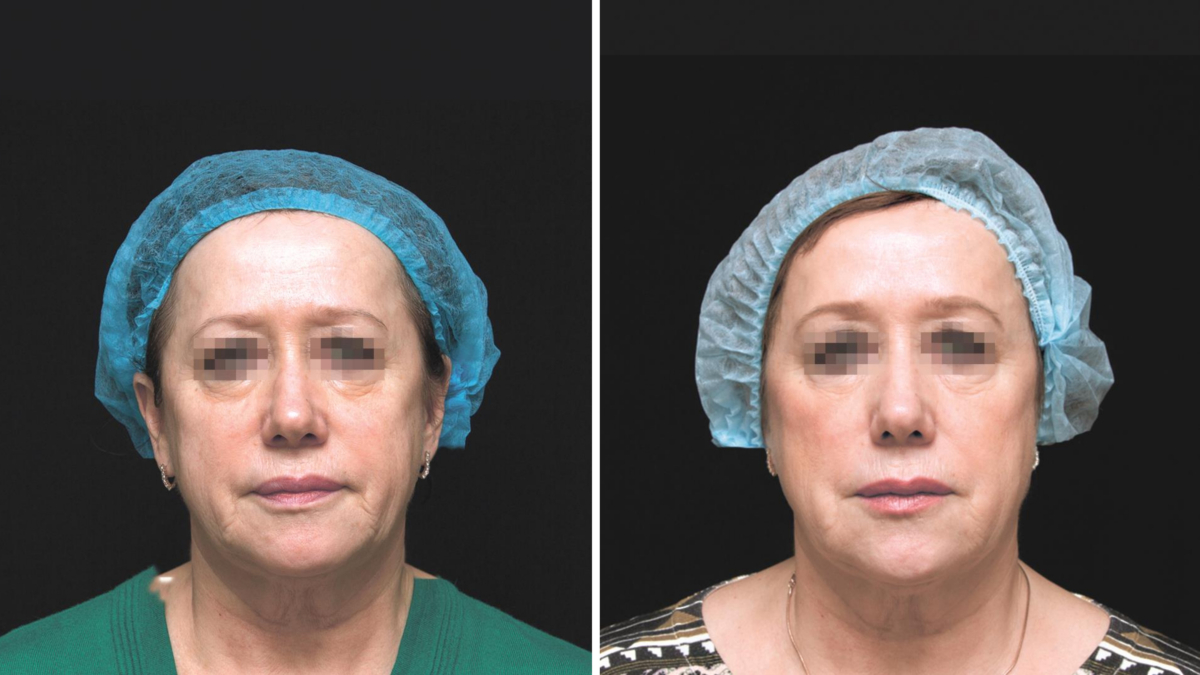 Biostimulators: What are they and how can they help my skin?