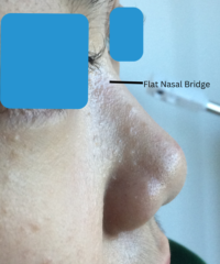 Common Nose Shapes And Their Treatments