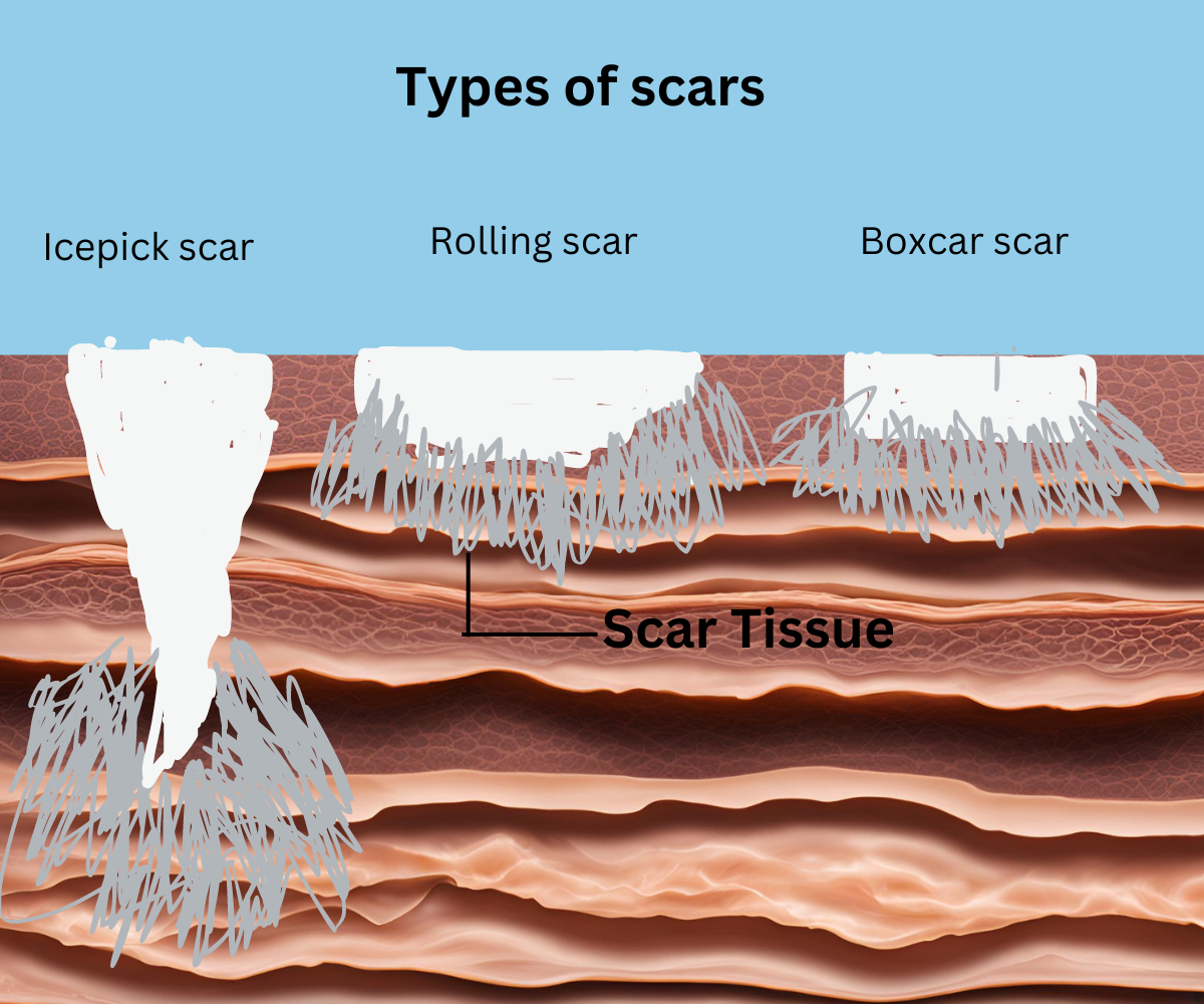 Acne Scars