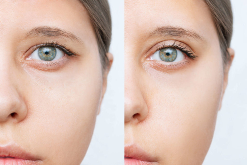 The Botox Eyebrow Lift - Everything You Need To Know